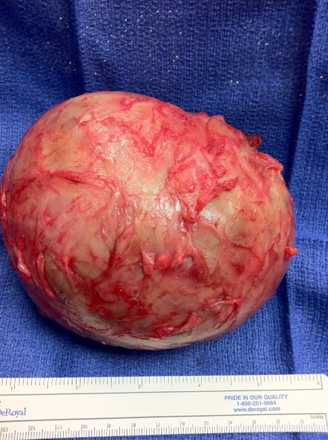 But I know, one thing, that I love you.: Fibroid