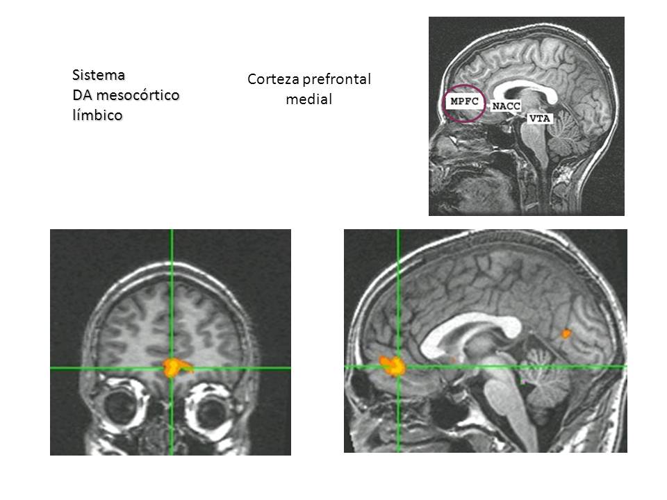 Neuroamor: "Escaneado el cerebro enamorado: El amor duele"