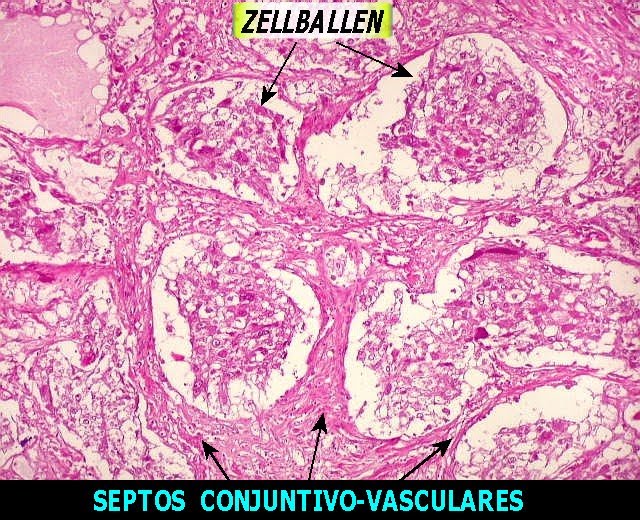 Liga de Patologia - UFC: FEOCROMOCITOMA