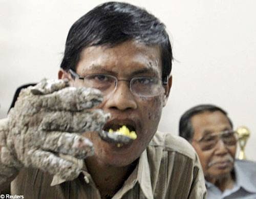 Dede Koswara After Treatment