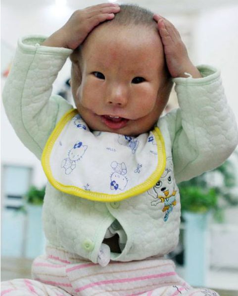 AMAZING: Chinese Boy Born with a Mask-Like Face