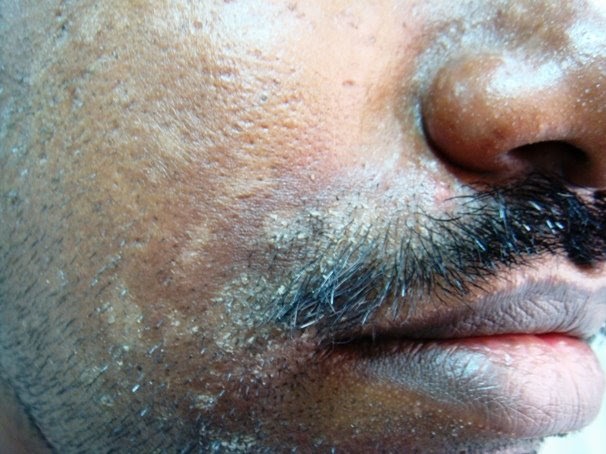 Skin Care Tips From Dermatologist: Seborrheic Dermatitis: Basic Facts