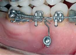 Anibal Ribeiro - Ortodontia: Protocolos dos mini-implantes Ortodônticos