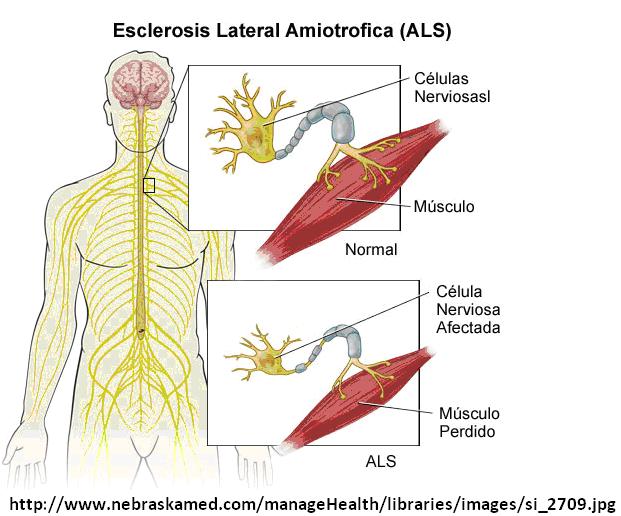 ELA: Historia de la ela (Esclerosis lateral amiotrofica)
