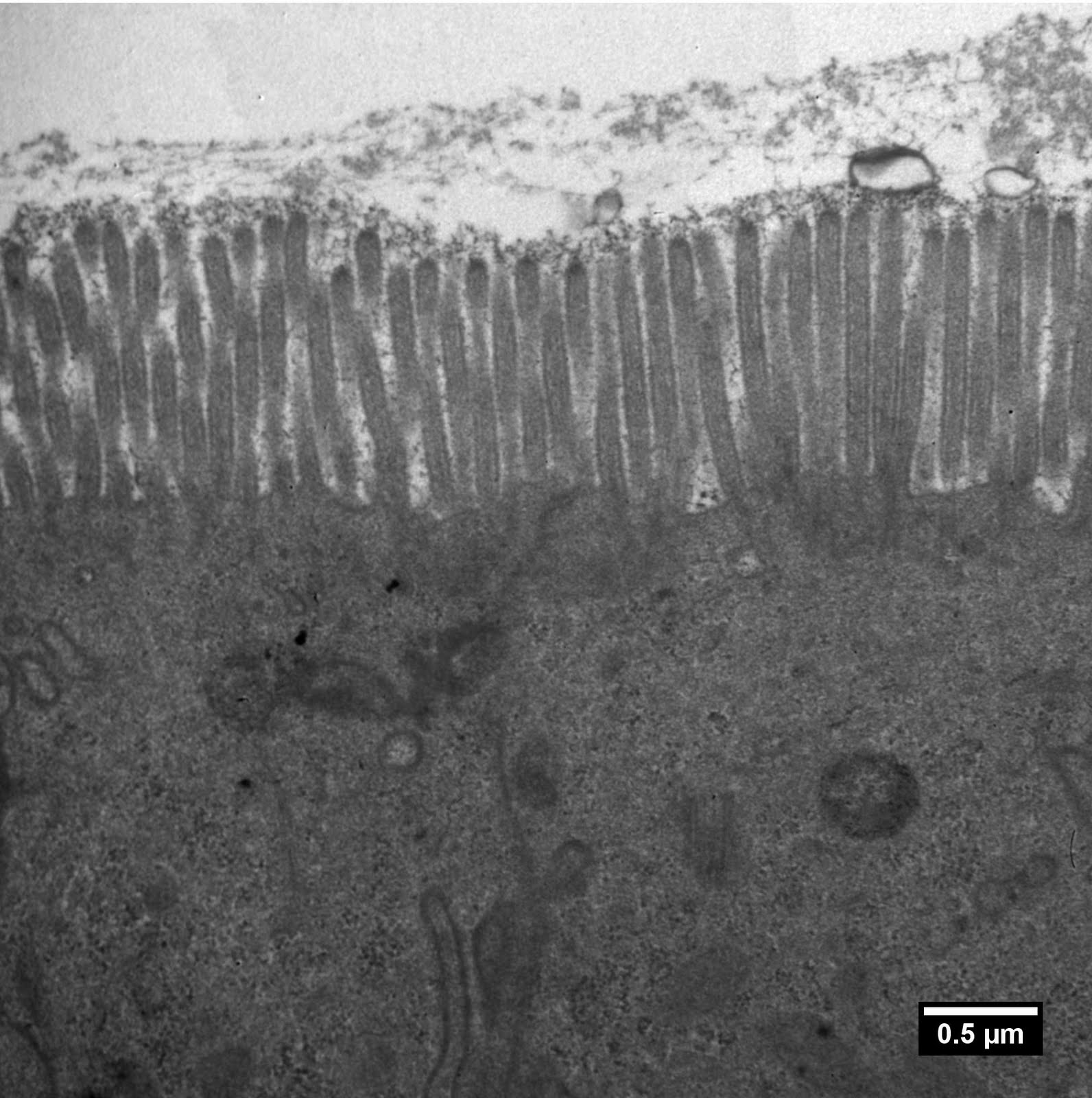 Celiac Disease: Gluten-free diet is the treatment
