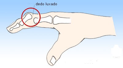 Fisioterapia Passo Fundo: LUXAÇÃO DO DEDO
