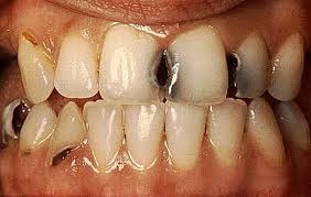 Treatment Options: What is Tooth Decay?