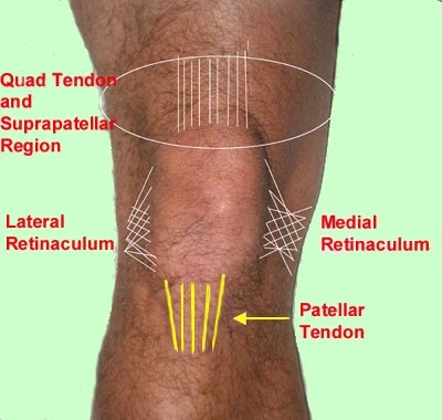 El blog de Francisco Gilo: Tendinitis rotuliana (Jumper`s knee)