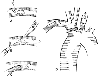 Dicky's CardioThoracic & Vasco: CPB 101. Anterograde, Retrograde and ...