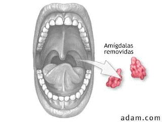 Curso tec. de enfermagem Evangélico: Amigdalectomia