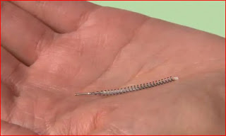Adiana Permanent Contraception - The Well-Timed Period