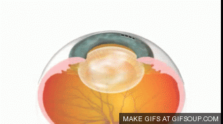 CATARACT: 18. Surgery Summary