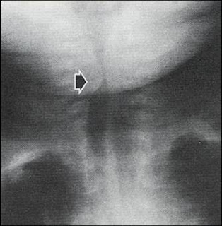 ENT for medical students: LARYNX - Examination