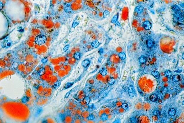 Anatomía Patológica: Lesión celular