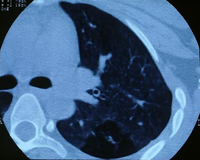 CT scan in internal medicine