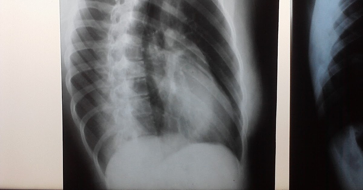 Rx 2010: Tórax Oblicuo Anterior Derecho e Izquierdo