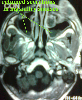 ummara shares: CA SUPRASTRUCTURE OF LEFT MAXILLARY ANTRUM