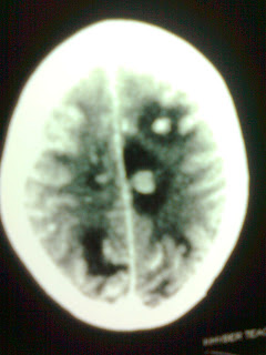 ummara shares: MULTIPLE ENHANCING NODULES IN BRAIN..