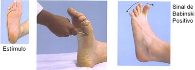 CONVERSA SOBRE MEDICINA: Sinal de Babinski