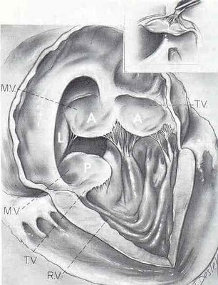 Pedi cardiology: Anatomy: AVSD - Rastelli Types