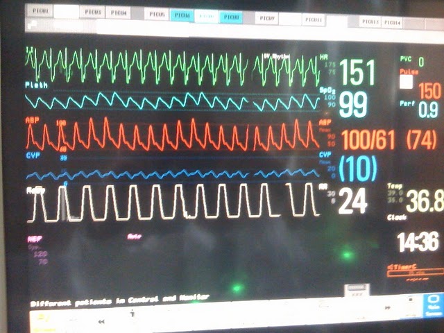 Pedi cardiology: ICU: Monitor - CVP trace analysis