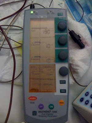 Pedi cardiology: ICU: Monitor - s/p Norwood - Temporary pacemaker ...