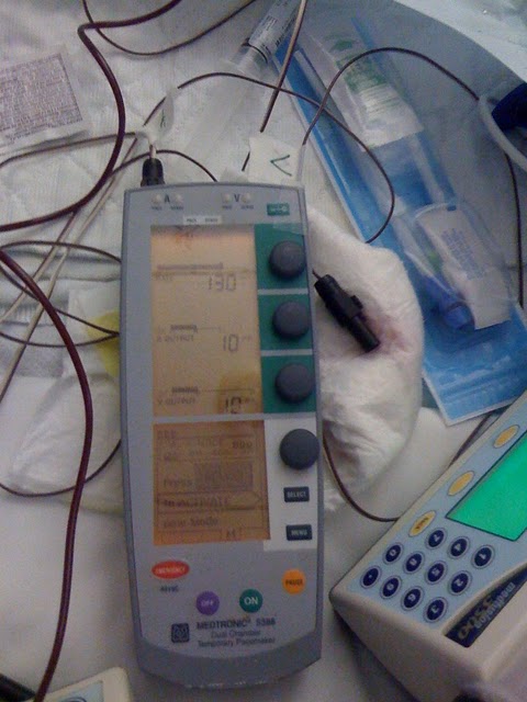 Pedi cardiology: ICU: Temporary Pacemaker