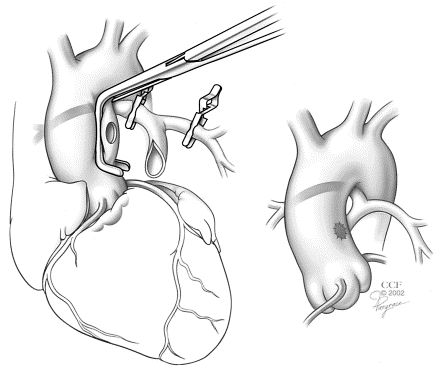 Pedi cardiology: Surgery: Pulmonary atresia - VSD, MAPCAs, Unifocalization