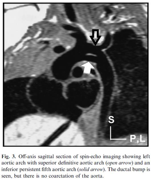 Pedi cardiology: Persistent fifth arch