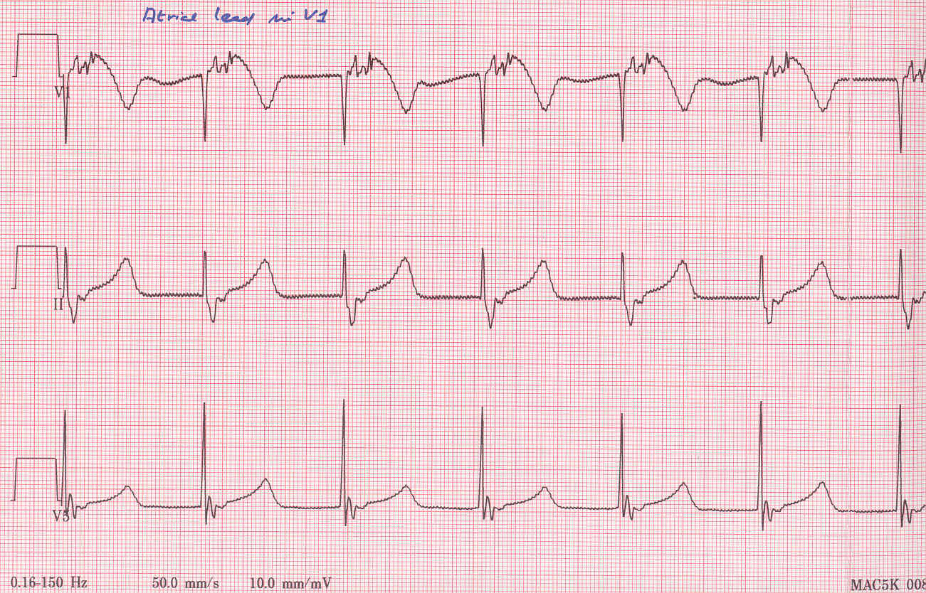 Pedi cardiology: EKG: Interpret this...