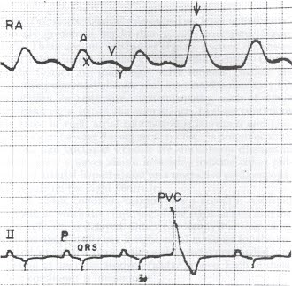 Pedi cardiology: Cath Lab: Pressure Trace, Giant a wave in RA