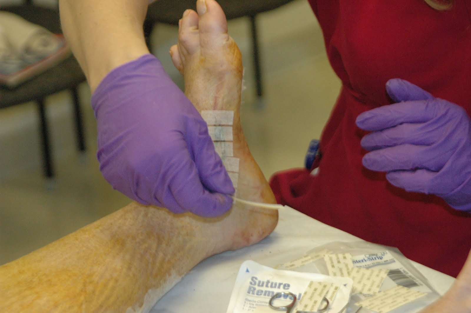 Posterior Tibial Tendon Surgery: Stitches out....new cast on