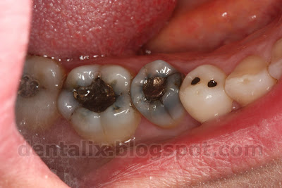 Odontología: Amalgama por composite en premolar inferior
