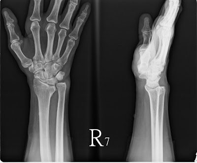 Big Bad: joint step-off: distal radial fracture