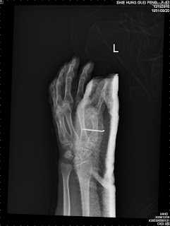 Big Bad: Basal joint OA s/p partial trapezium excision and soft tissue ...
