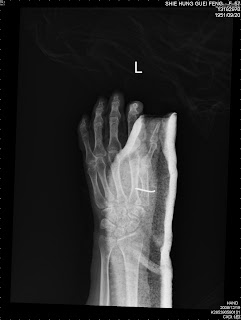 Big Bad: Basal joint OA s/p partial trapezium excision and soft tissue ...