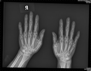 Big Bad: Basal joint OA s/p partial trapezium excision and soft tissue ...