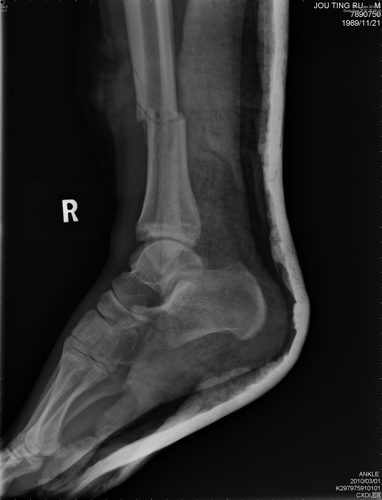 Big Bad: Neighbor tibia low shaft fracture with good callus formation