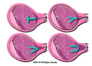 Minha história: Imcompetencia Istmo Cervical