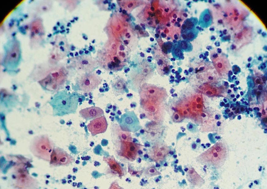 Citotecnologia: CAMBIOS INFLAMATORIOS EN CÉLULAS PAVIMENTOSAS DE ...