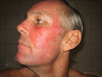 myefudixphotos: day 32 ( day 17 ) post efudix