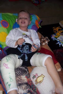 Ryan's Blog: Spica Cast, Two Years Later