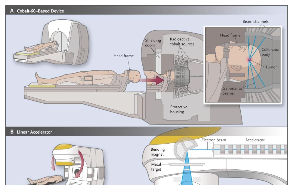 Phimaimedicine: 452. Stereotactic radiosurgery for the management of ...