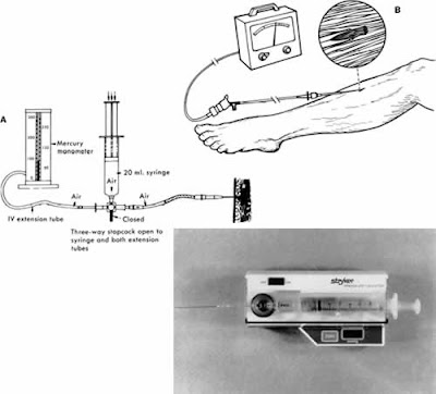 Phimaimedicine: 615. Compartment syndrome/measurement pressure