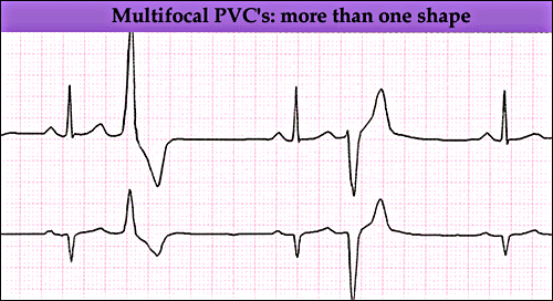 Phimaimedicine: 719. Multifocal premature ventricular complex