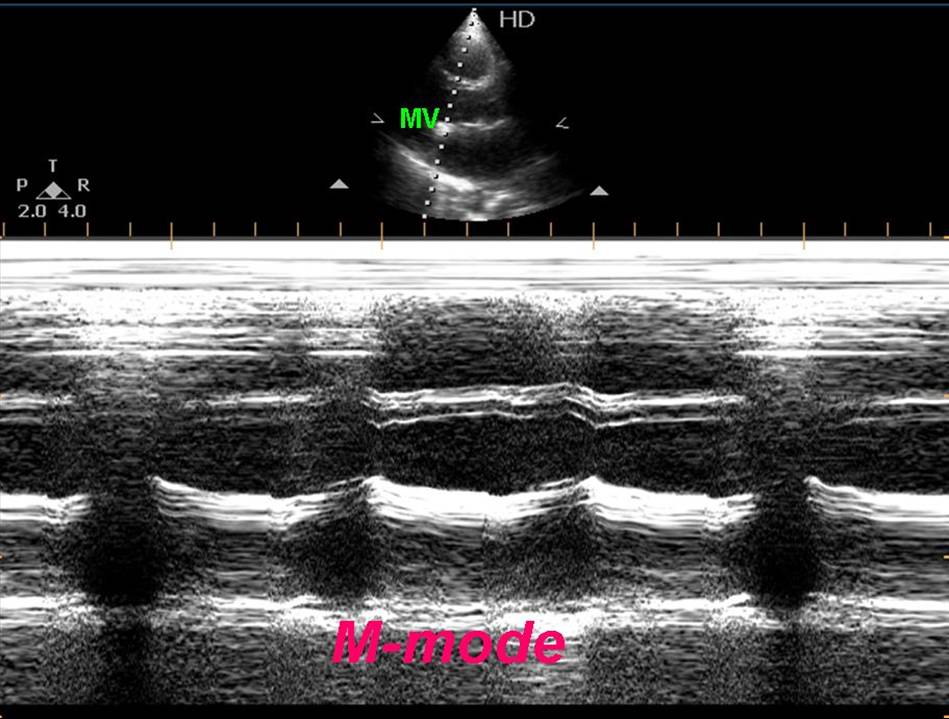 Phimaimedicine: 837. Mitral stenosis