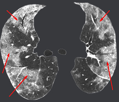 e-CT SCAN: HRCT LUNGS-GROUND GLASS OPACITY