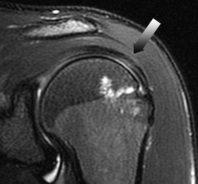UNDERSTANDING MRI: MRI OF SHOULDER IMPINGEMENT SYNDROME