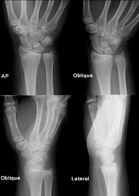 BASIC X-RAY: WRIST - NORMAL ANATIOMY