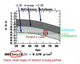 Nuclear Medicine - Another Way Of Learning: BONE DENSITOMETRY
